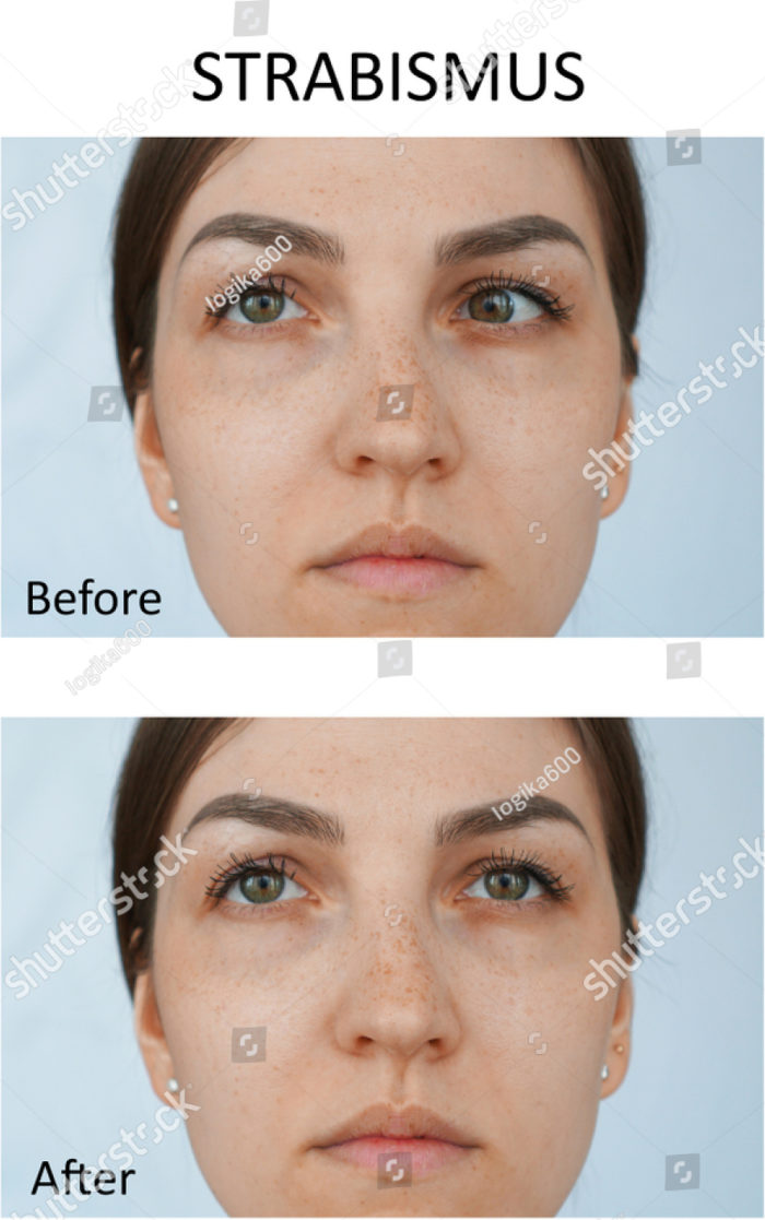 Strabismus / Squint - Blackrock Eye Care