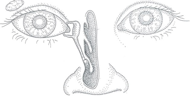 Nasolacrimal Duct Obstruction – Blocked Tear Ducts - Treatments