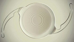 Intraocular Lenses IOL’s - Blackrock Eye Care
