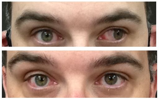 Strabismus Overview – Strabismus Causes and Treatments